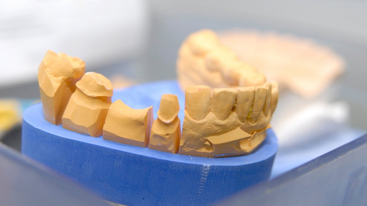 Ein Backenzahn fehlt – was tun?