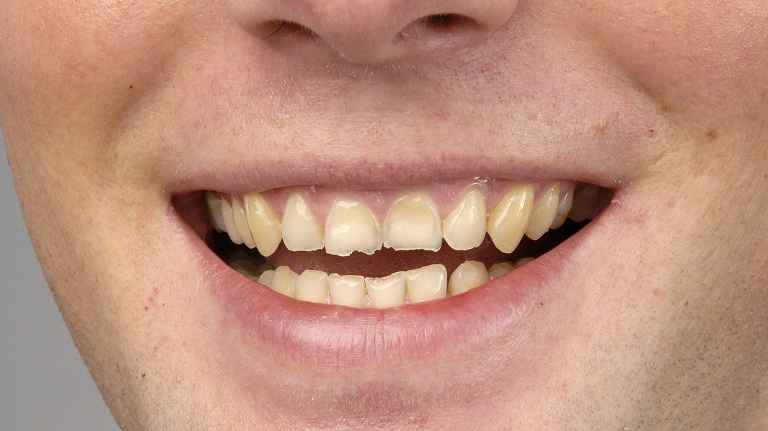 Zahn-Veneers: Wann sind sie sinnvoll?